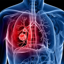 John V. Heymach | MD Anderson Cancer Center