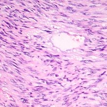 Patrick P. Lin | MD Anderson Cancer Center