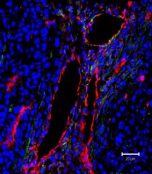 John V. Heymach | MD Anderson Cancer Center